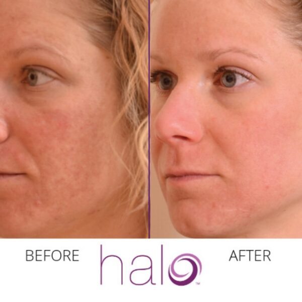 Halo Skin Treatment: What You Should Expect from
