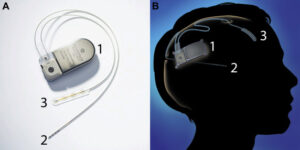 NEUROPACE RNS System: Focal Epilepsy Treatment Device