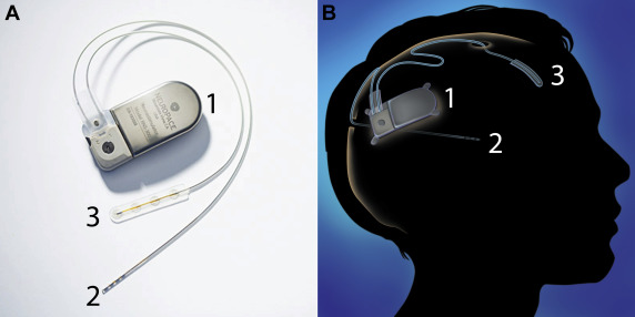 NEUROPACE RNS System: Focal Epilepsy Treatment Device