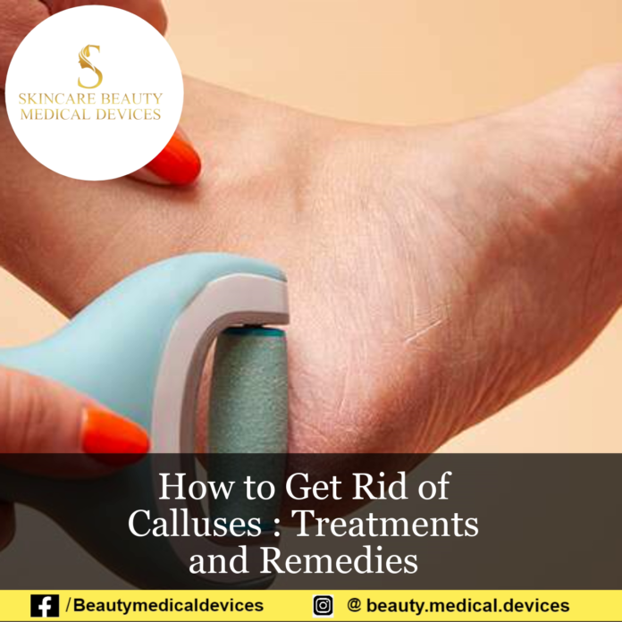How to Get Rid of Calluses : Treatments and Remedies