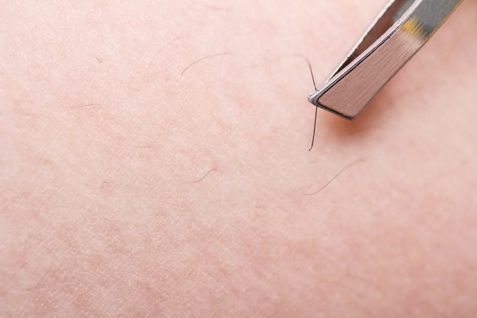 Ingrown Hair Symptoms Treatment Permanent Prevention