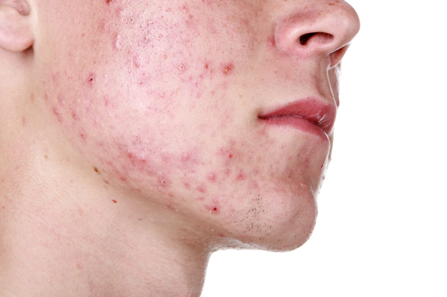 Cystic Acne: Treatments and Causes Explained by Top Dermatologists