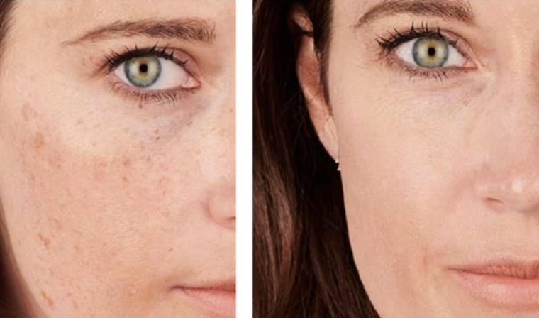 How Does the Opte Device Work? : Beauty Device