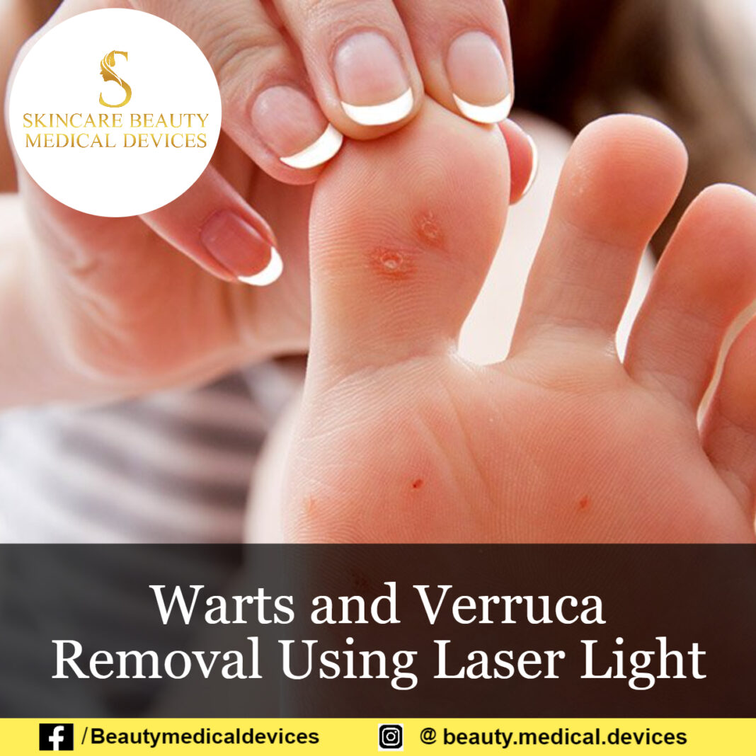 Warts and Verruca Removal Using Laser Light : Treatment