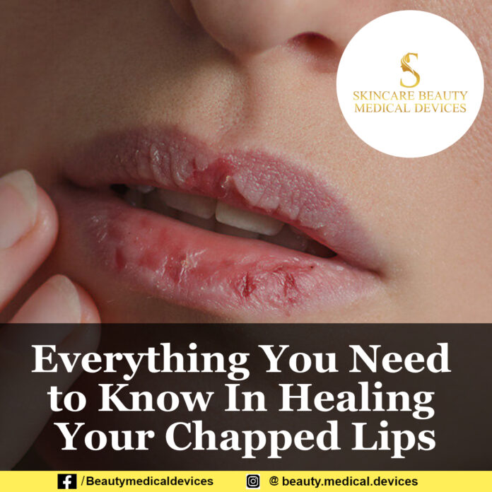 Everything You Need to Know In Healing Your Chapped Lips