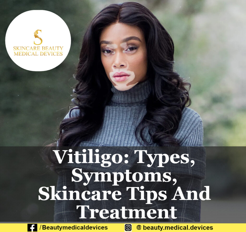 Vitiligo: Types, Symptoms, Skincare Tips And Treatment