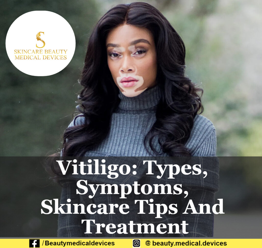 Vitiligo: Types, Symptoms, Skincare Tips And Treatment