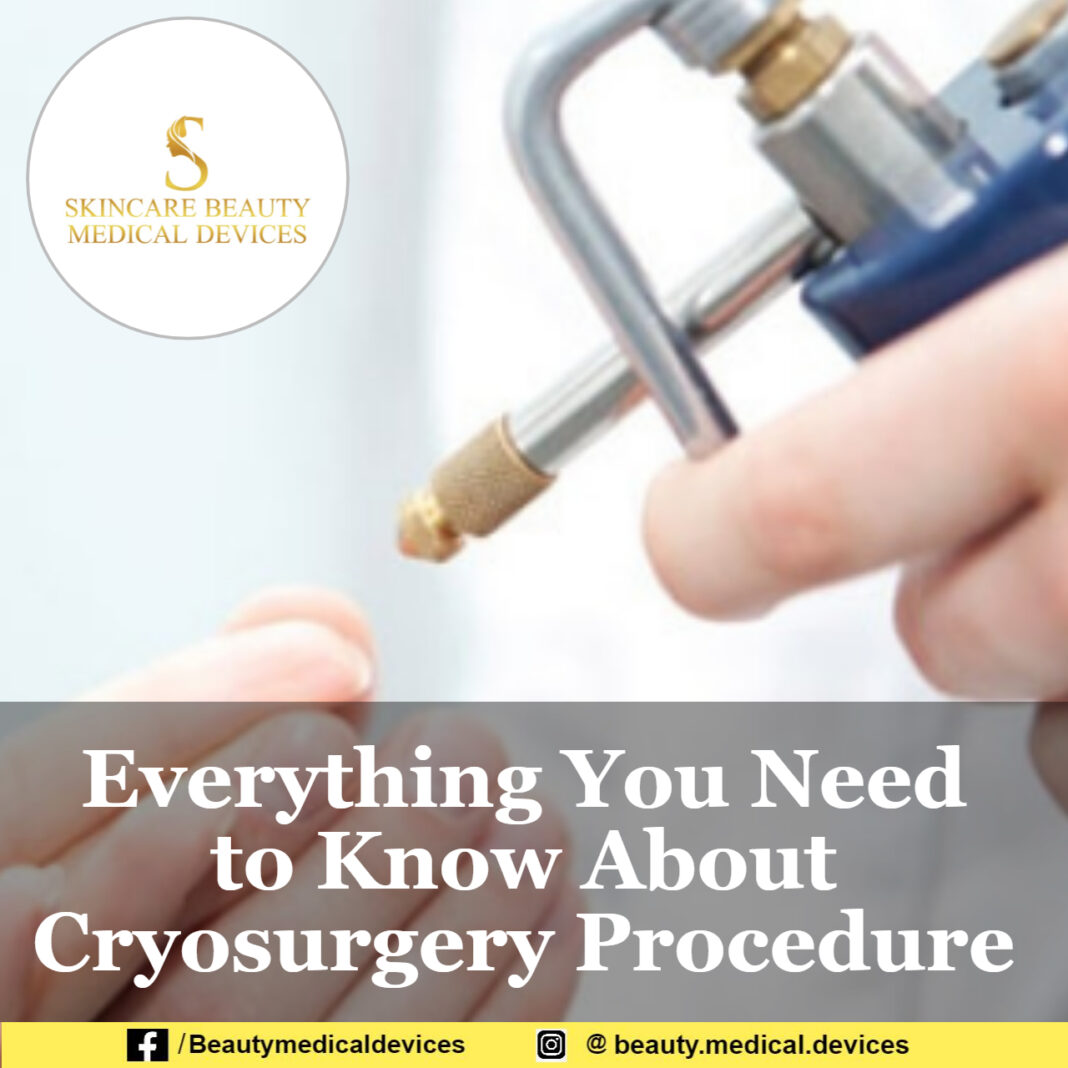 Everything You Need to Know About Cryosurgery Procedure