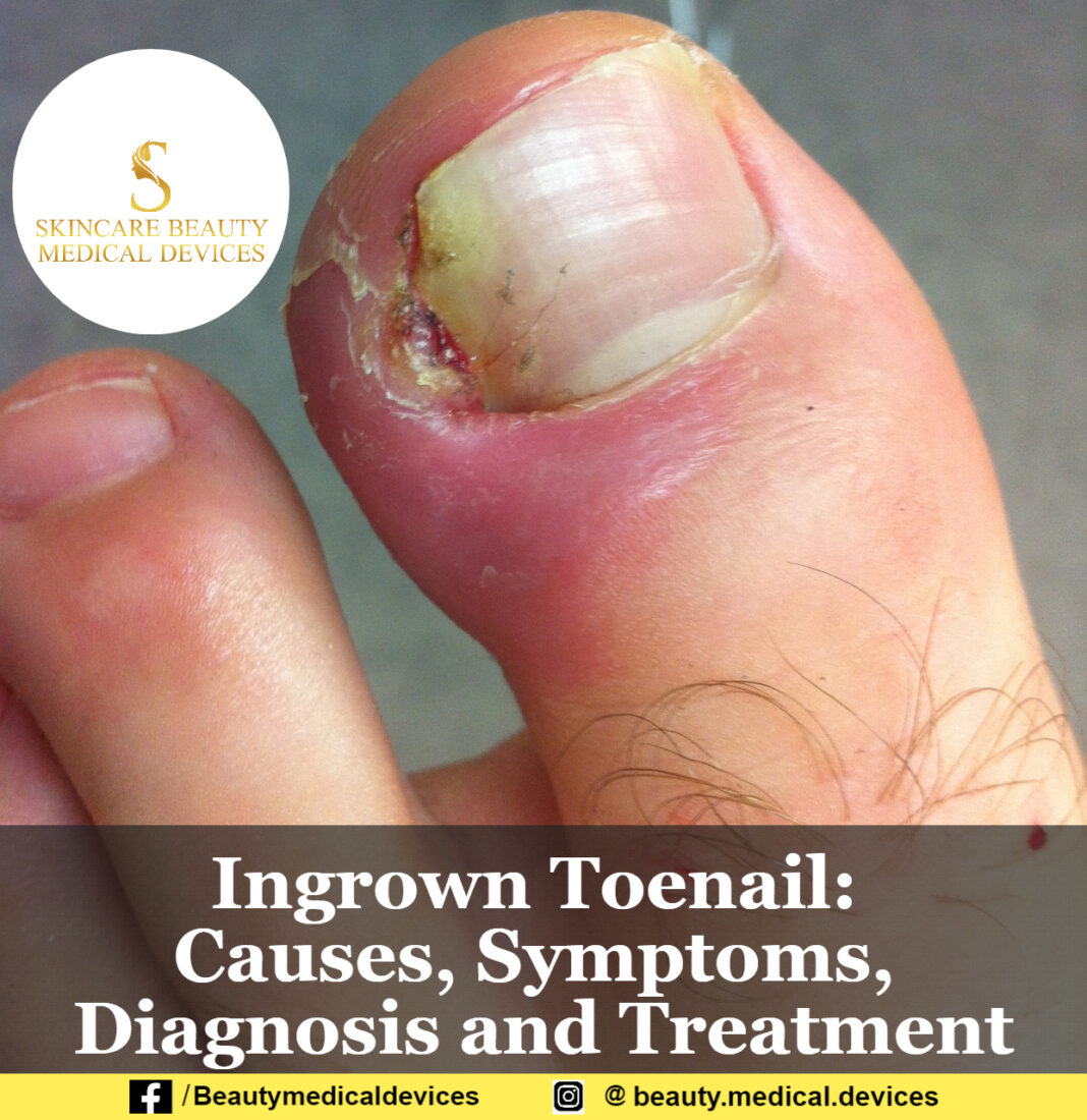 Ingrown Toenail: Causes, Symptoms, Diagnosis and Treatment