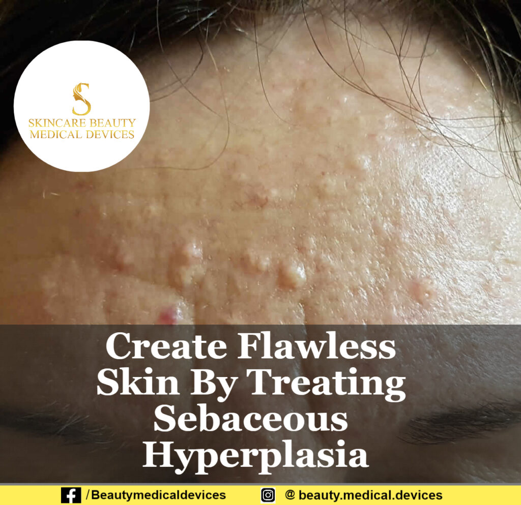 Create Flawless Skin By Treating Sebaceous Hyperplasia