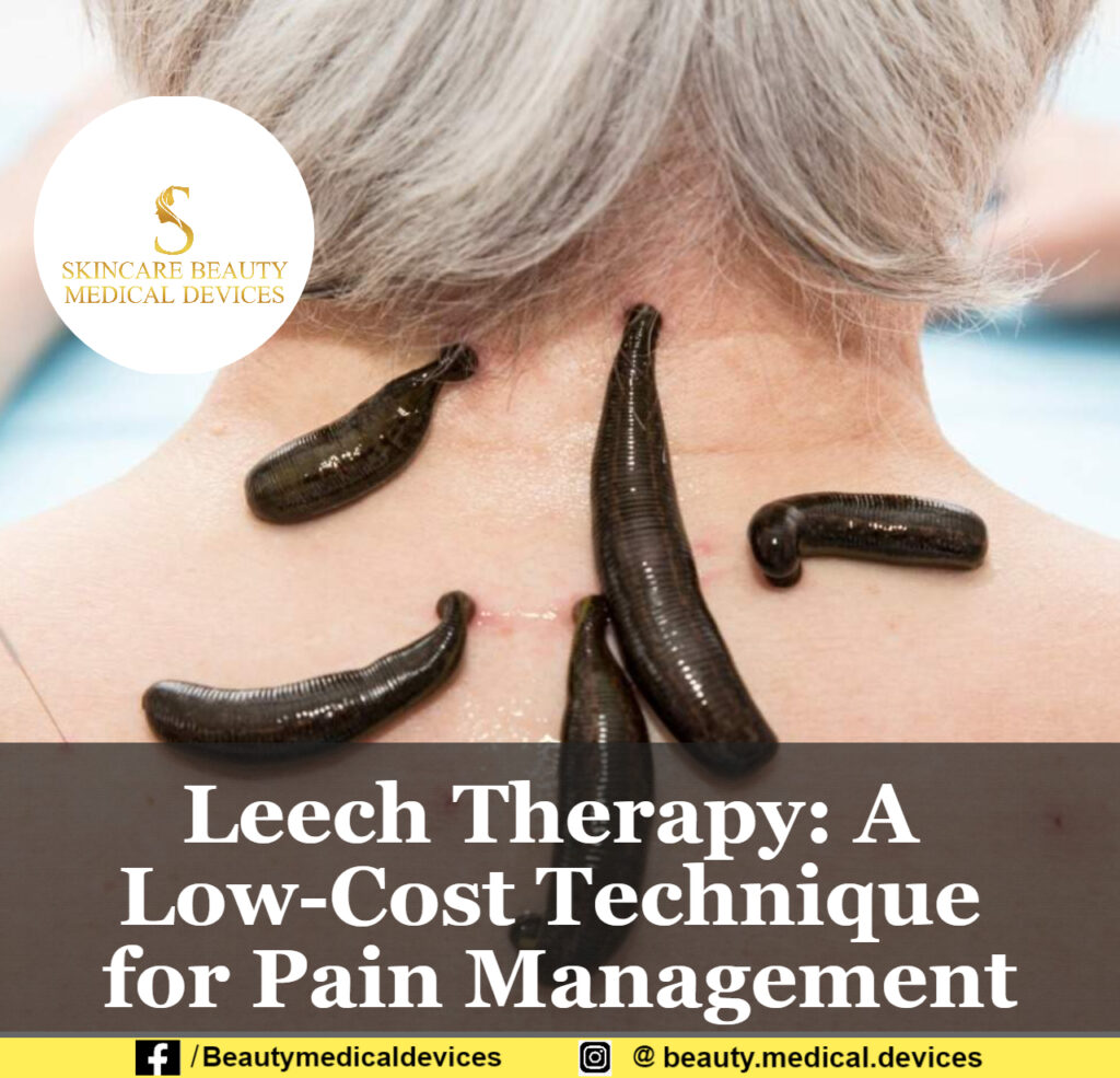 Leech Therapy: A Low-Cost Technique for Pain Management