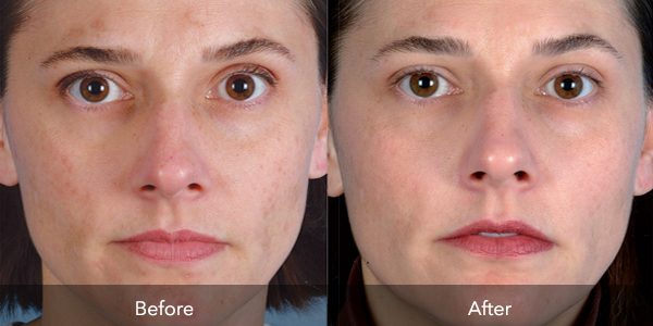 Let’s Talk About Microdermabrasion