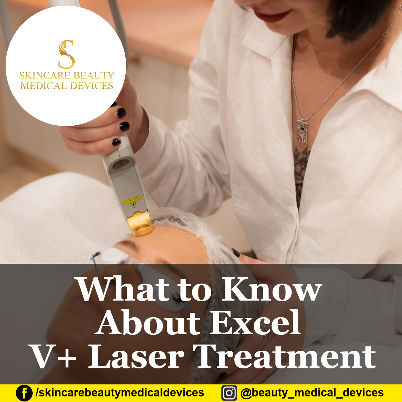 What to Know About Excel V+ Laser Treatment
