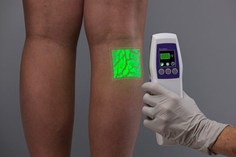 Vein Finder Displays Veins Beneath the Surface