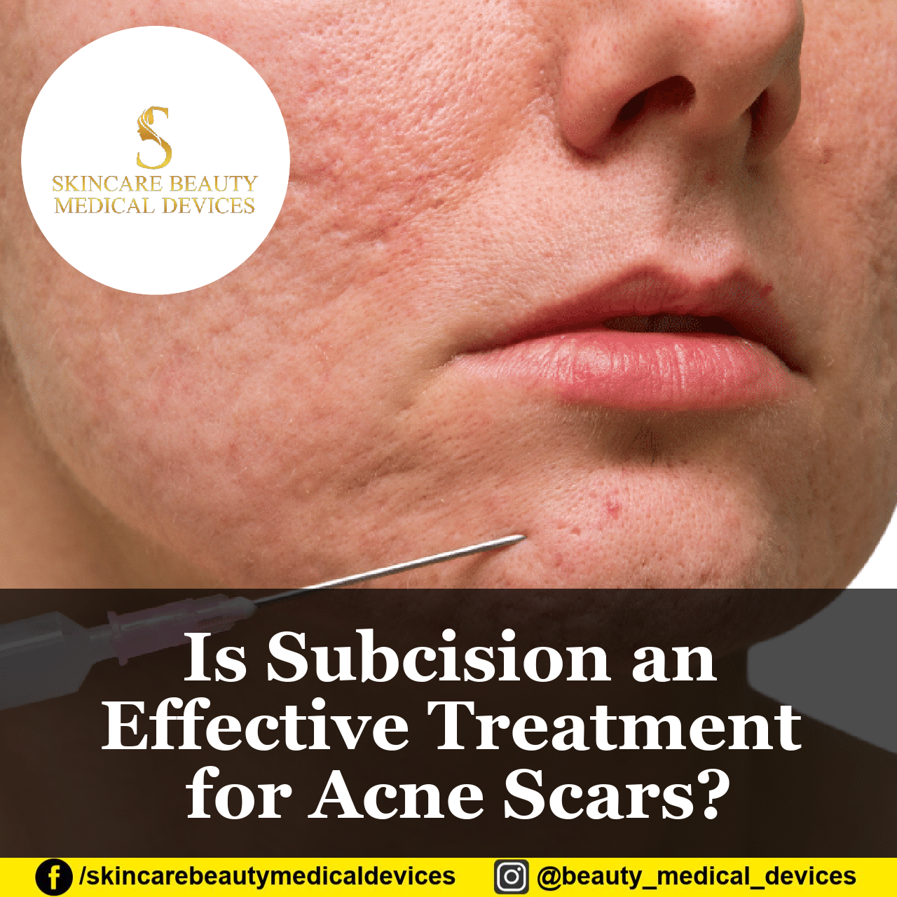 Is Subcision an Effective Treatment for Acne Scars?