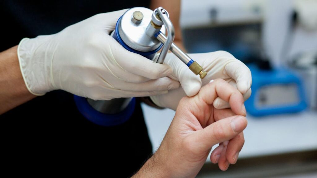 Cryotherapy: Is Freezing Warts an Effective Treatment?