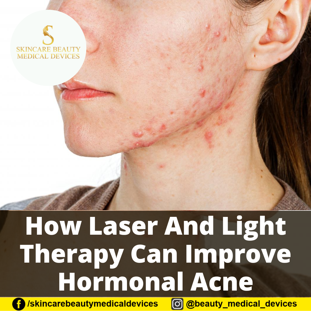 How Laser And Light Therapy Can Improve Hormonal Acne