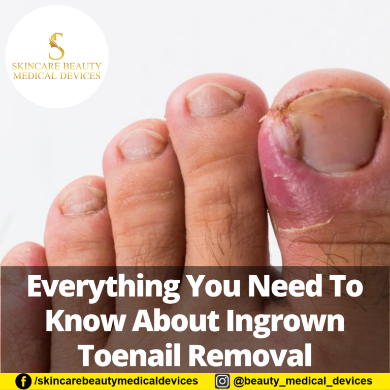 Everything You Need To Know About Ingrown Toenail Removal
