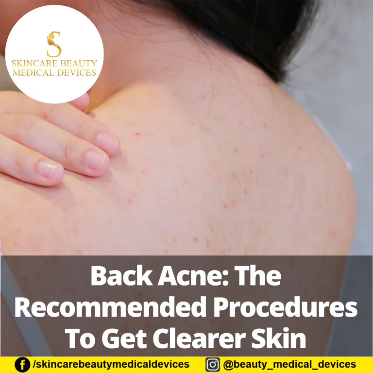 Back Acne: The Recommended Procedures To Get Clearer Skin