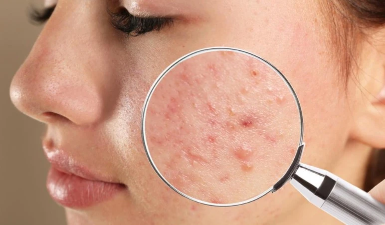 All About Fungal Acne And Its Treatments
