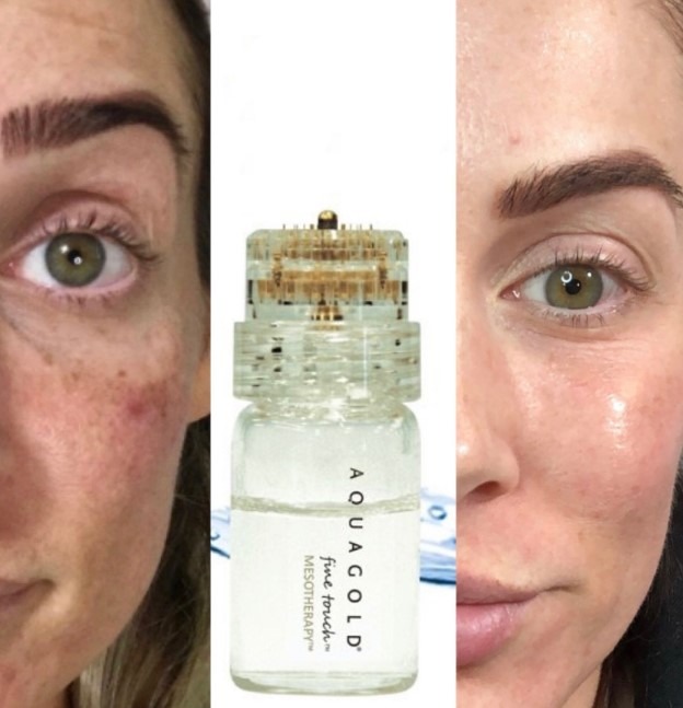 The details about Luxurious Micro Infusion Aquagold facial benefits