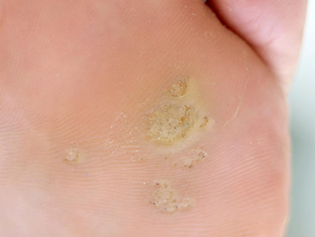 Understanding Calluses: Causes, Prevention, and Treatment