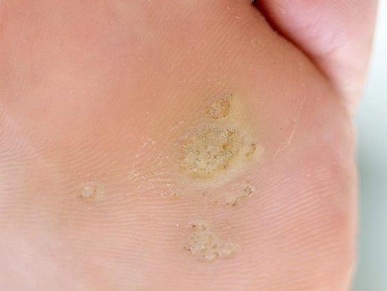 Understanding Calluses: Causes, Prevention, and Treatment