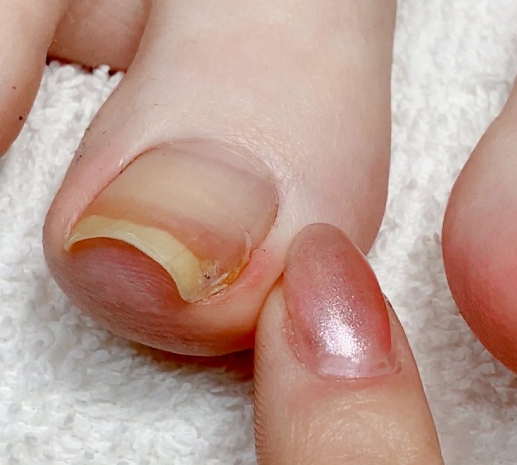 Demystifying Ingrown Toenail Removal: A Comprehensive Guide